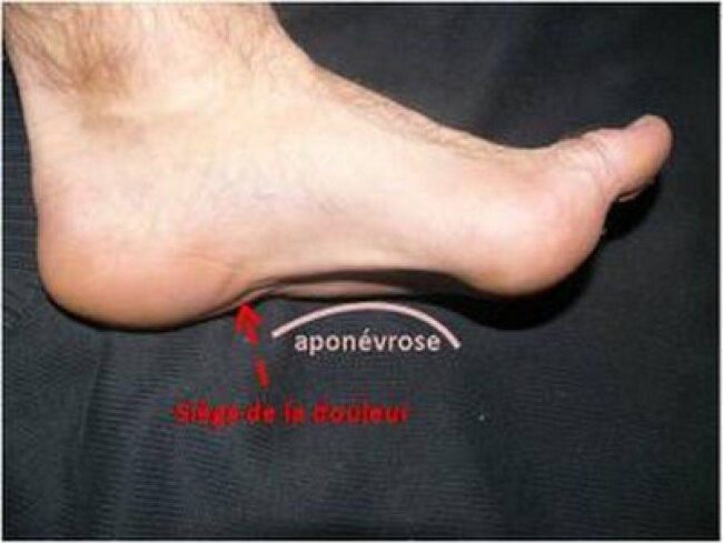 Aponévrosite plantaire : puis-je essayer de recourir ? - Jogging ...